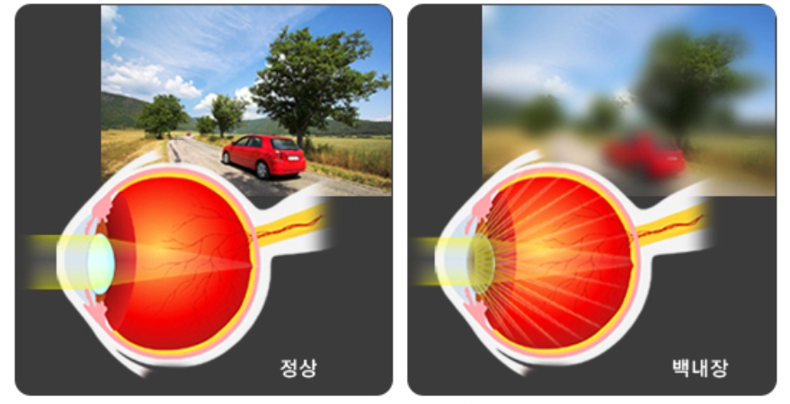 백내장 재수술이 필요한 4가지 상황! | 성모진안과 블로그